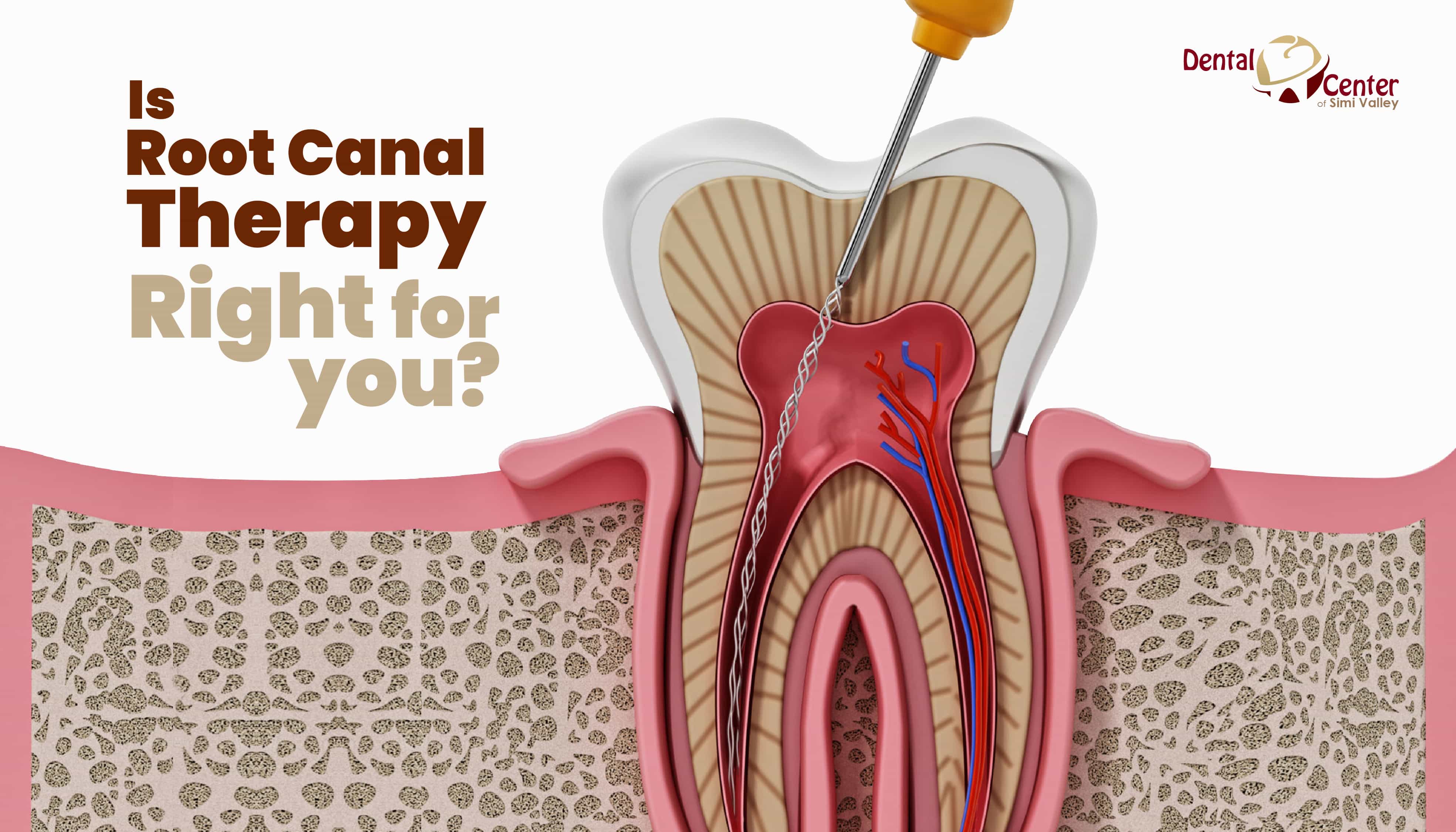 Simi Valley Dentist Offers Root Canal Treatment